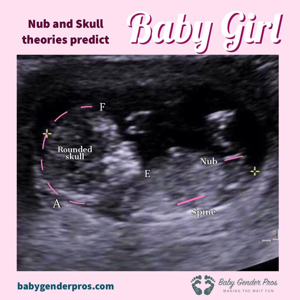 Understanding Nub Theory Ultrasound Images - Baby Gender Pros