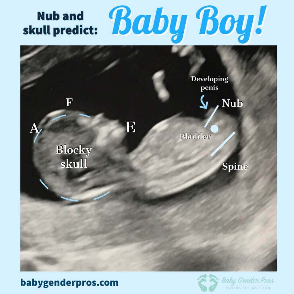 Understanding Nub Theory Ultrasound Images - Baby Gender Pros