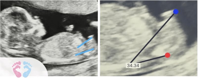 Understanding Nub Theory Ultrasound Images - Baby Gender Pros